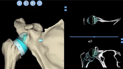 B2 Glenoid Critical Assessment & Virtual Implantation using BLUEPRINT™ 3D Planning Software with ...